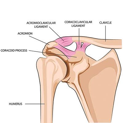Image result for AC Joint Dysfunction