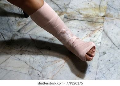 Image result for Splinter Foot