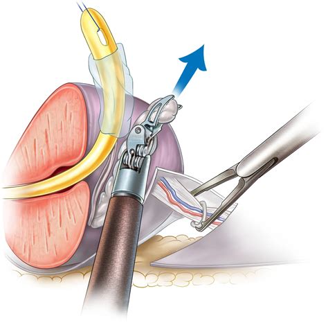Image result for Prostatectomy Surgery Procedure