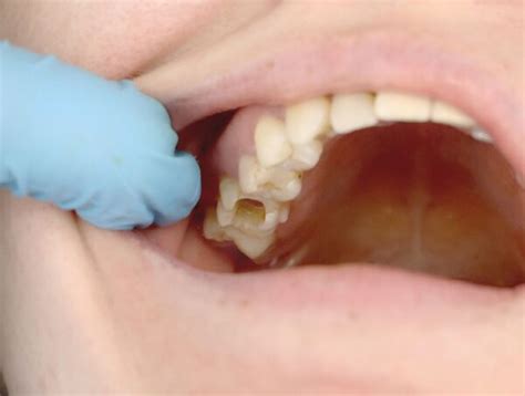 Image result for Avulsed Tooth