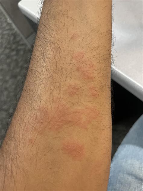 Image result for Shingles On Arm