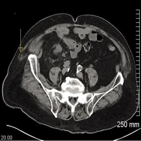 Image result for Urogram CT Scan with Contrast Normal