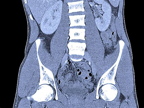 Image result for Urogram CT Scan with Contrast Normal