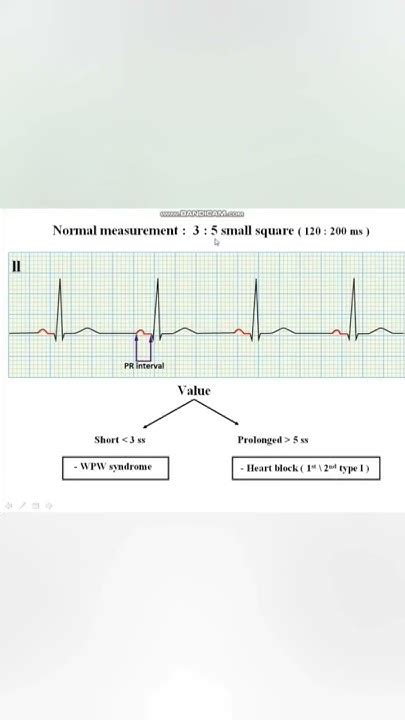 Image result for Normal PR Interval Fetus