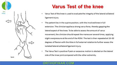 Image result for Varus Test Knee