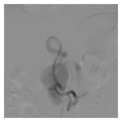 Image result for Spinal Angiogram