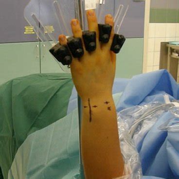 Image result for Wrist Arthrogram