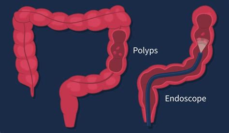 Image result for Control Colonoscopy of Polyps