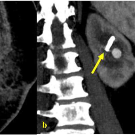 Image result for Urogram 3 Phase CT