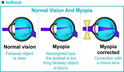Image result for Vision Defects Myopia