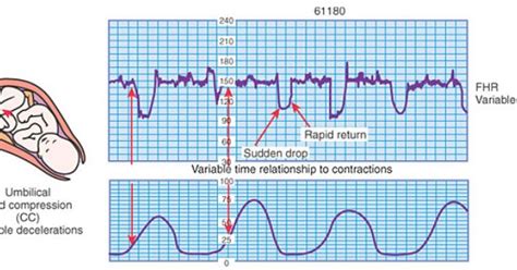 Image result for Variable Decelerations