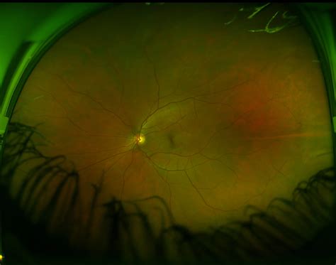 Image result for Retinal Imaging