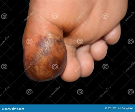 Image result for Cellulitis Toe