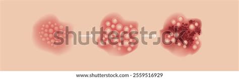 Shingles Stages Royalty-Free Images, Stock Photos & Pictures | Shutterstock