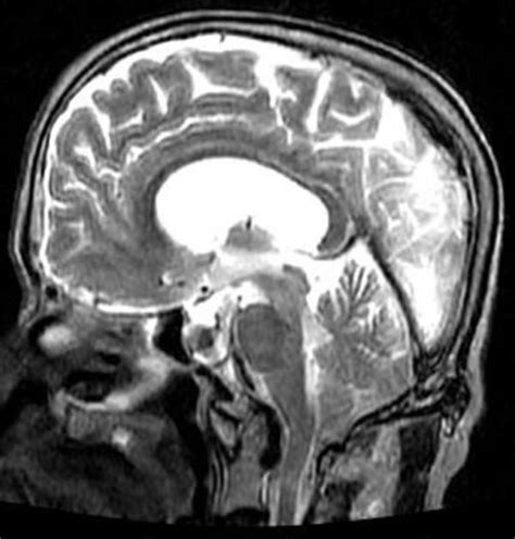 Image result for X-Rays for Basilar Invagination