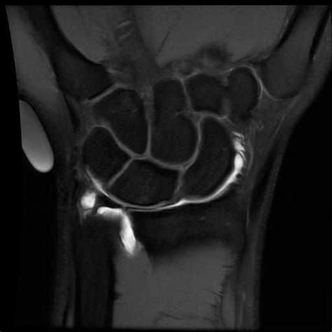 Wrist MR arthrogram