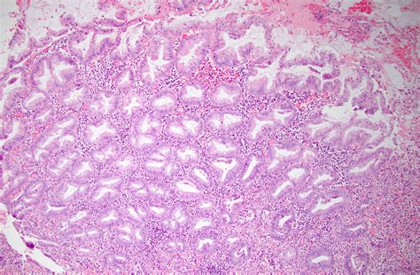 Image result for Colonoscopy Frequency Hyperpplastic Polyp