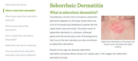Image result for Seborrheic Dermatitis Contagious