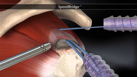Image result for SpeedBridge Methods