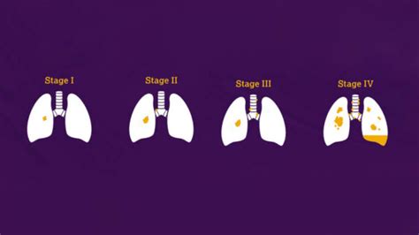 Image result for How Fast Can Lung Cancer Develop