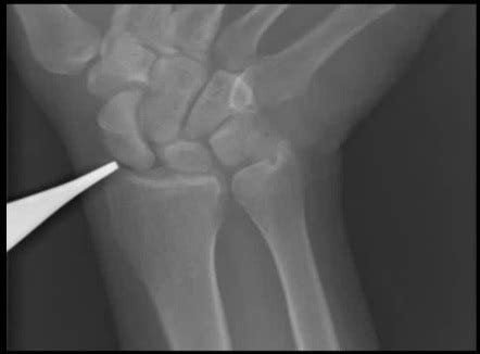 Image result for Wrist Arthrogram