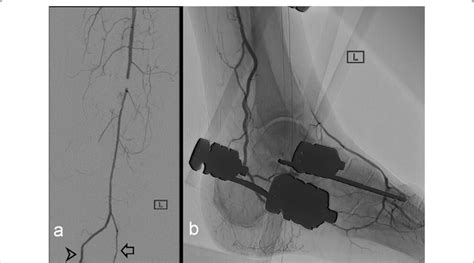 Image result for Left Lower Extremity Angiogram