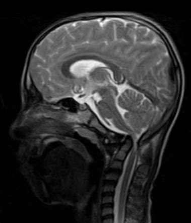 Image result for X-Rays for Basilar Invagination