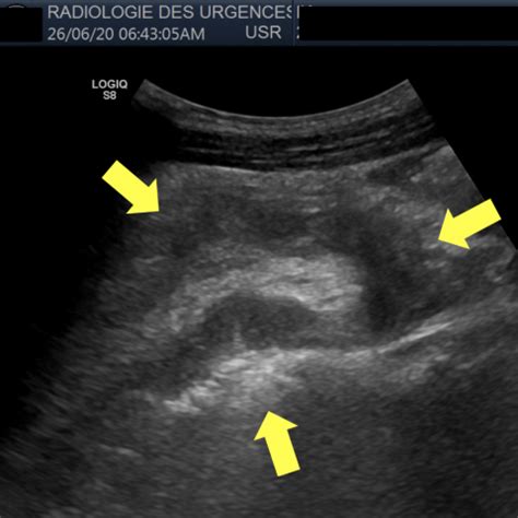 Image result for Intussusception Pseudokidney Sign