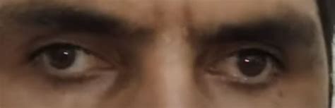 Image result for Exotropia and Computer