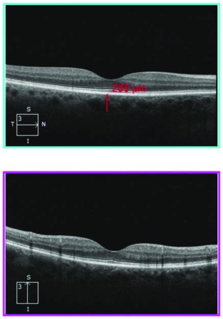Image result for Oct Line Scan