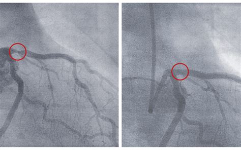 Image result for Different Types of Angiogram