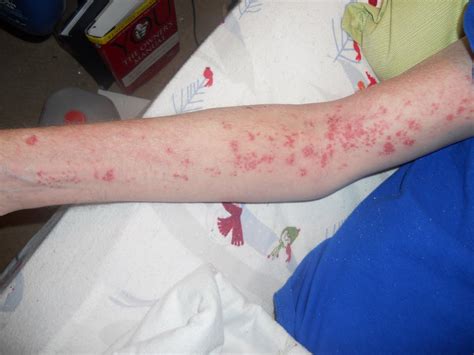 Image result for Shingles On Arm