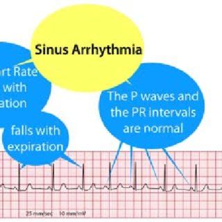 Image result for PR Interval Duration Normal