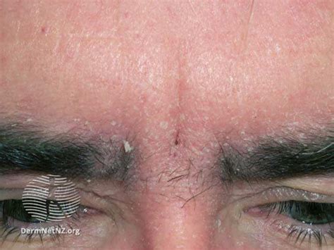 Image result for Seborrheic Dermatitis Contagious