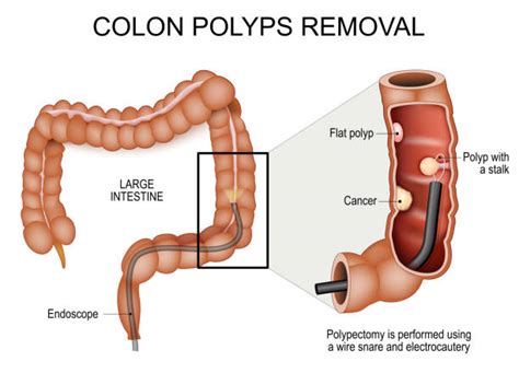 Image result for Colonoscopy Clips for Polyps