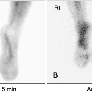 Image result for Triple Phase Bone Scan