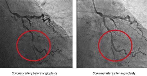 Image result for Heart Block Angiogram