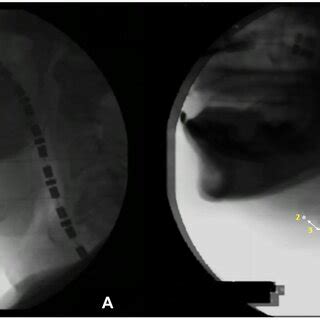 Image result for VFSS Procedure