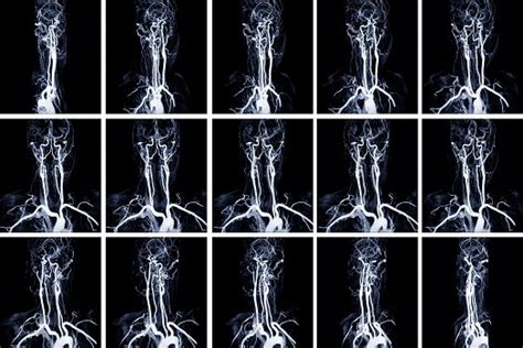 Image result for Spinal Angiogram