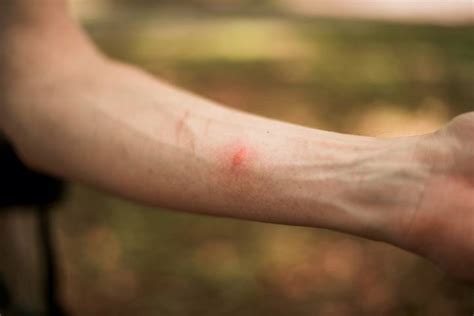 Image result for Cockroach Bites On Humans