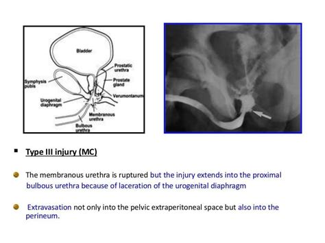 Image result for Urethrogram Procedure