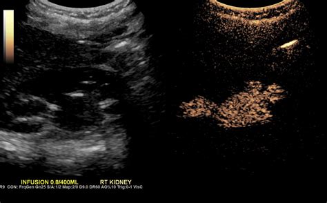 Pediatric Contrast-Enhanced Voiding Urosonography Tips | The Scan