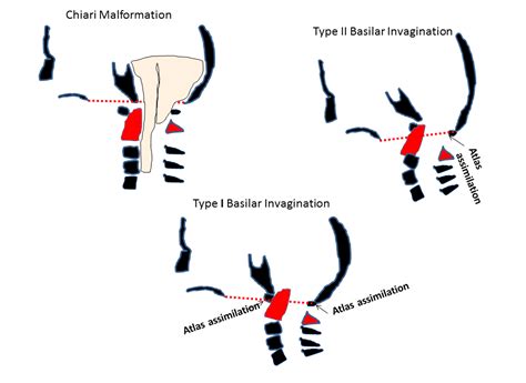 Image result for X-Rays for Basilar Invagination