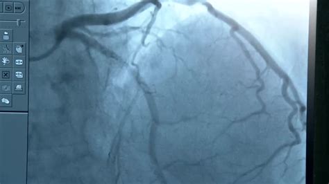 Image result for Peripheral Angiogram