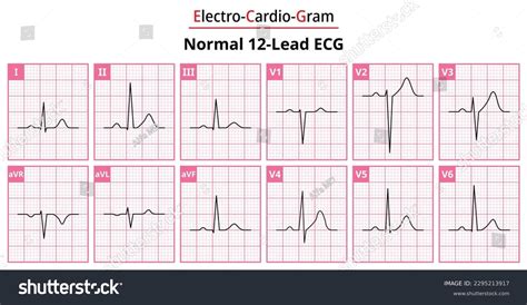 Image result for Normal EcG