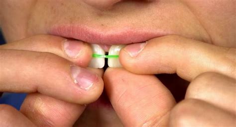 Image result for DIY Teeth Removal