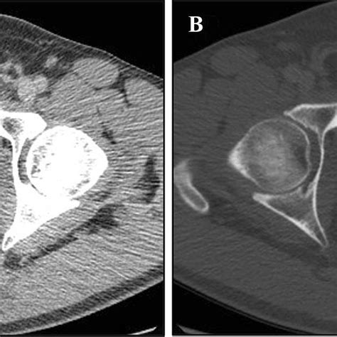 Image result for Urogram 3 Phase CT