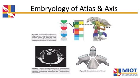 Image result for Basilary Invagination