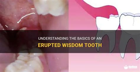 Image result for Wisdom Tooth Overlap