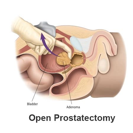Image result for Simple Prostatectomy Surgery